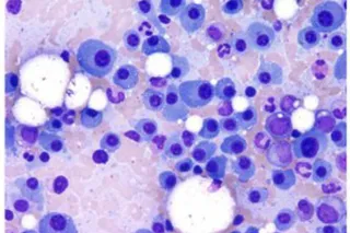 Early data show promise of BMS’ mezigdomide in pre-treated MM | The ...